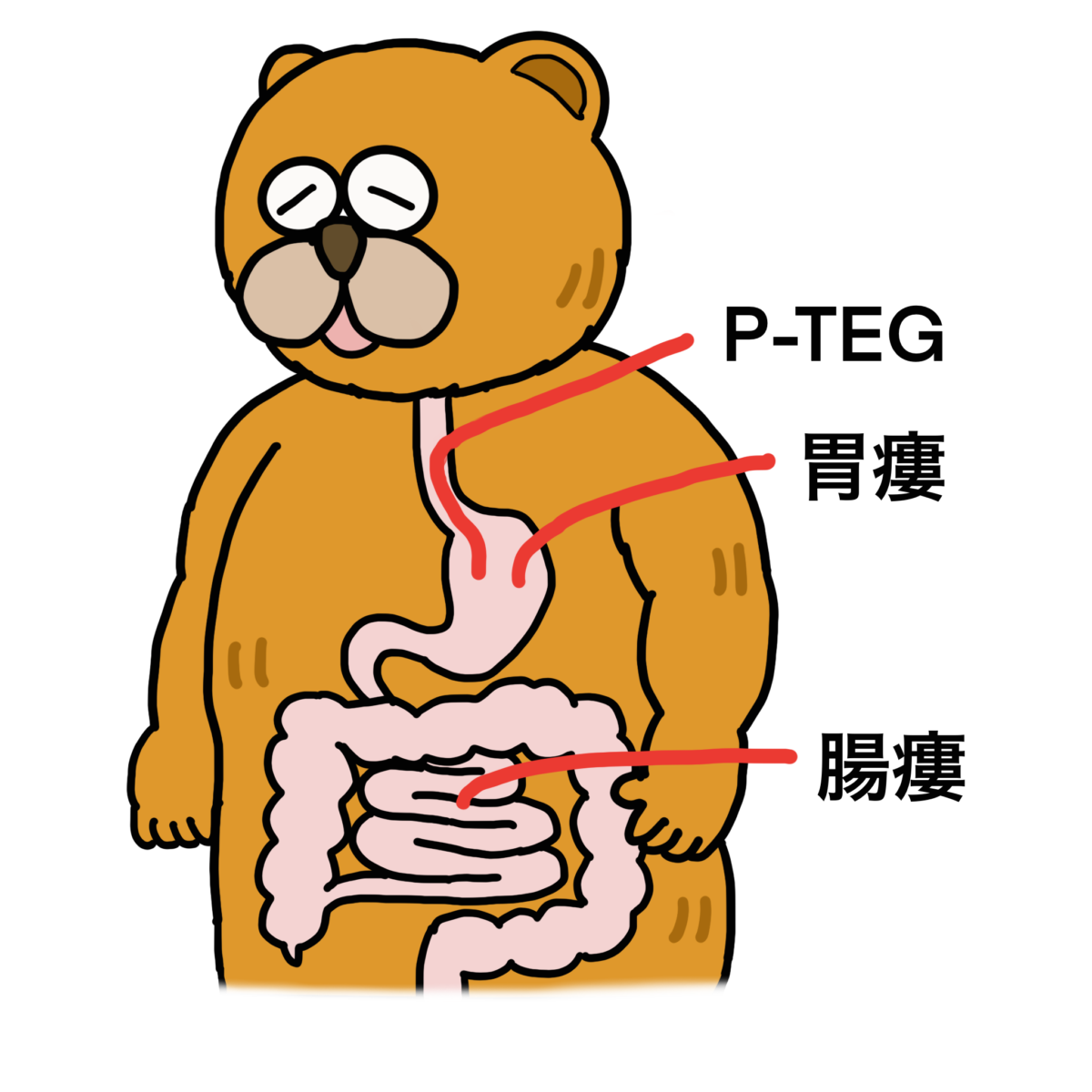 胃瘻、腸瘻、P-TEGのイラスト – すぐに使える！リハビリのイラスト集